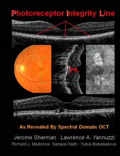Photoreceptor Integrity Line As Revealed By Spectral Domain Oct