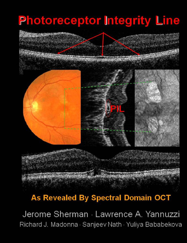 Photoreceptor Integrity Line as Revealed by Spectral Domain OCT