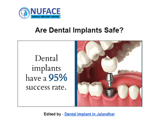 Exploring The Safety Of Dental Implants Risks Complications And