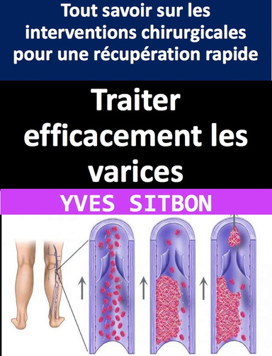 Traiter efficacement les varices : Tout savoir sur les interventions chirurgicales pour une ...